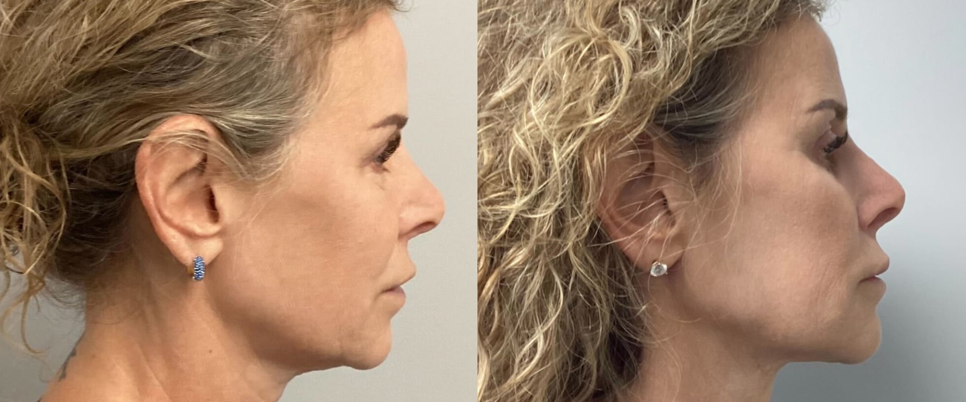 Transform Your Neck with Liquid Lift Treatment